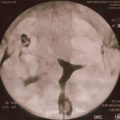Hysterosalpingography (HSG) – Fertility Center & Applied Genetics Of ...